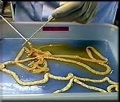 What is the longest tapeworm ever removed from a person? – Healthfacts.blog